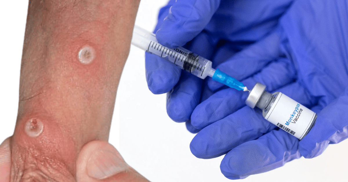 Monkeypox | Symptoms, How It Spreads, and the Vaccine - HB Tech